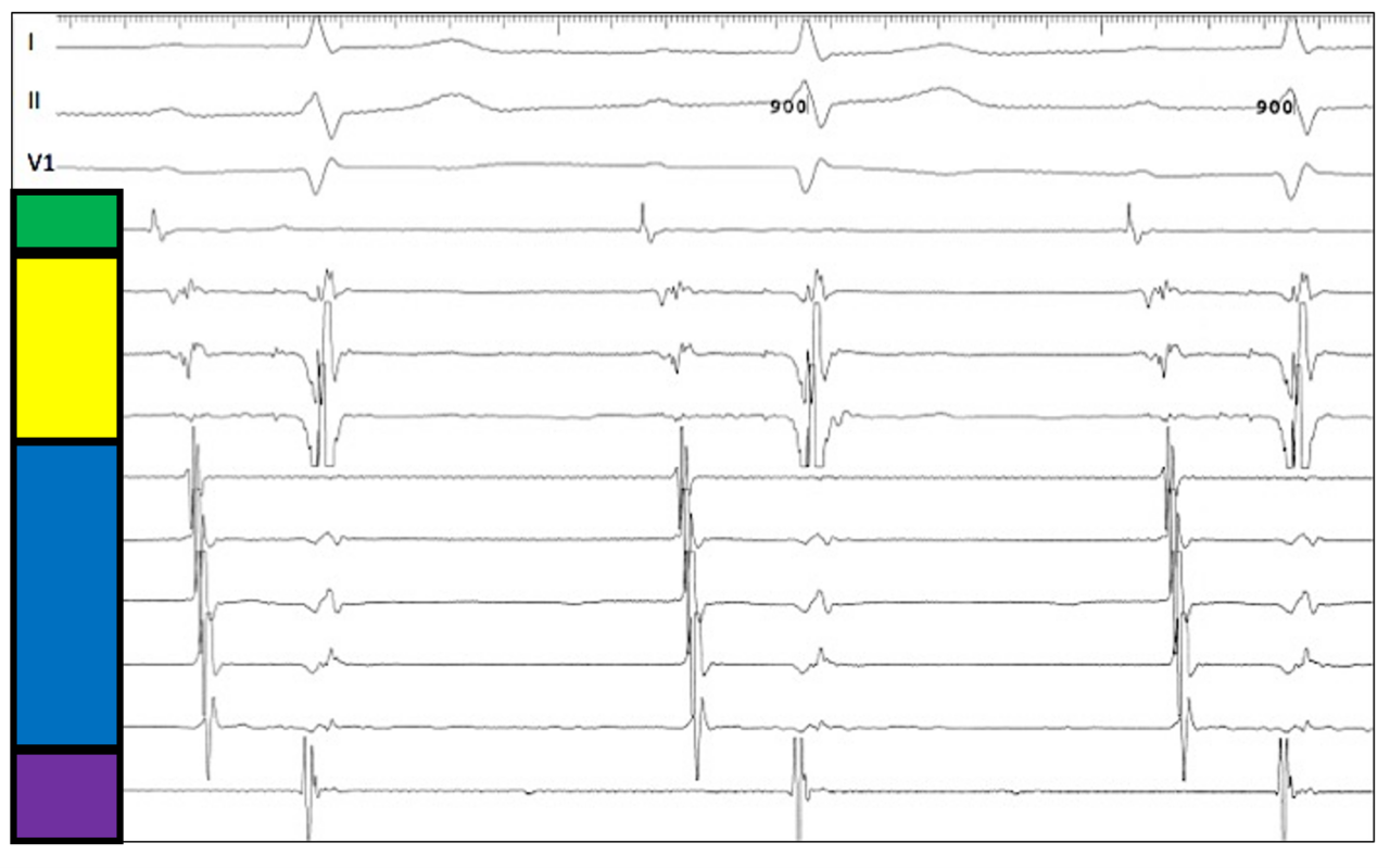 EP 101 - More Signals & Catheters - EP Essentials