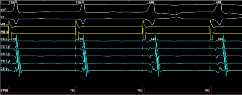Differential Pacing - Part 1 - EP Essentials