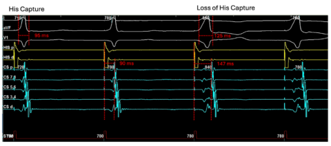 Differential Pacing - Part 1 - EP Essentials