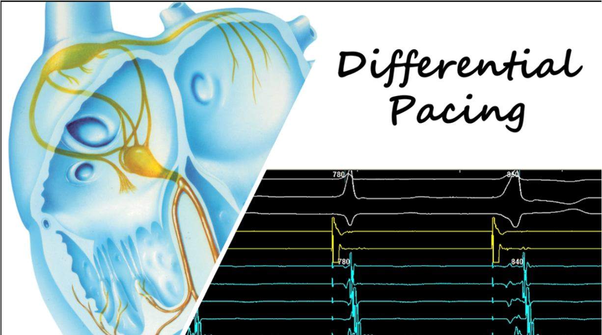Differential Pacing - Part 1 - EP Essentials