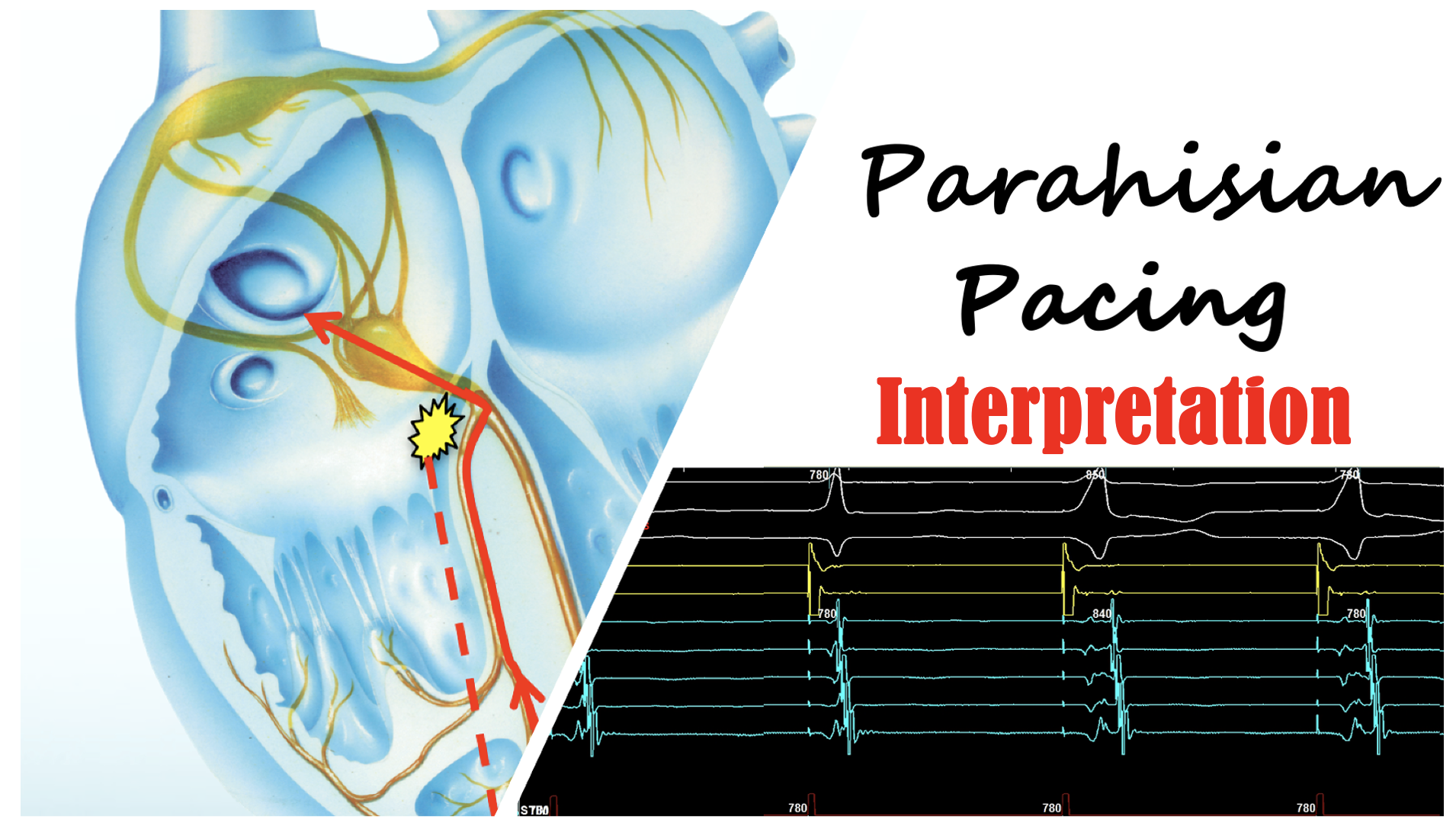 Differential Pacing - Parahisian Pacing Interpretation - EP Essentials