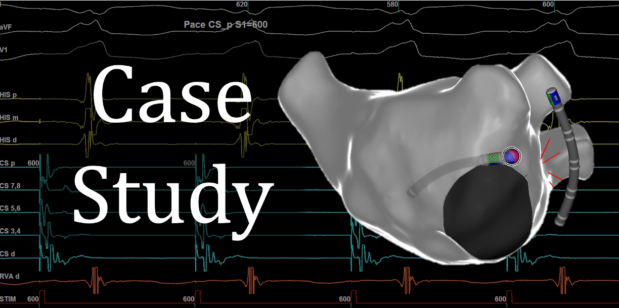 SVT Case Study - #4 - EP Essentials